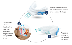 O2Vent Oventus | Dental Sleep Medicine Cairns